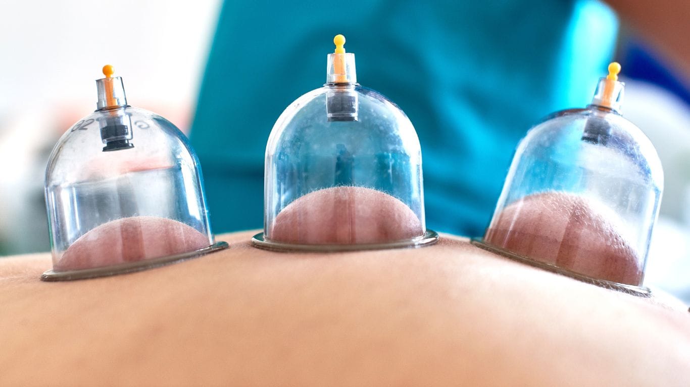 Cupping Therapy at Physio Cure Dubai